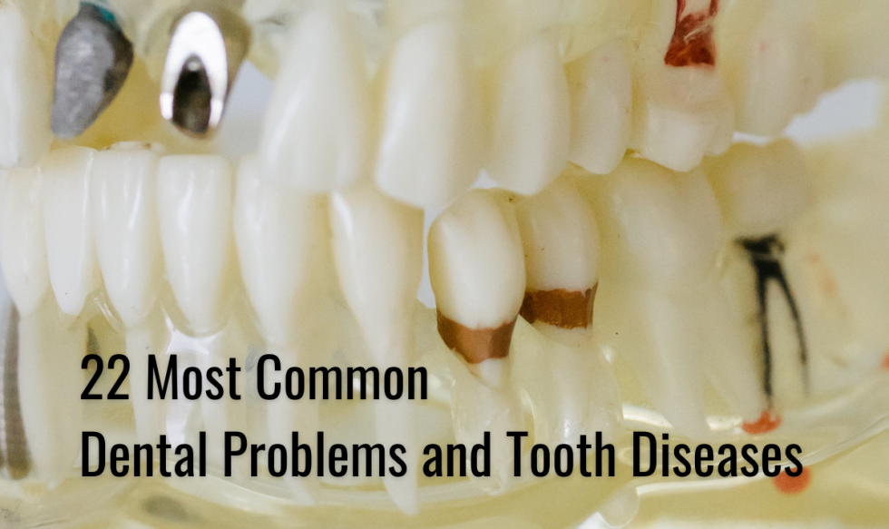 22 Most Common Dental Problems and Common Tooth Diseases